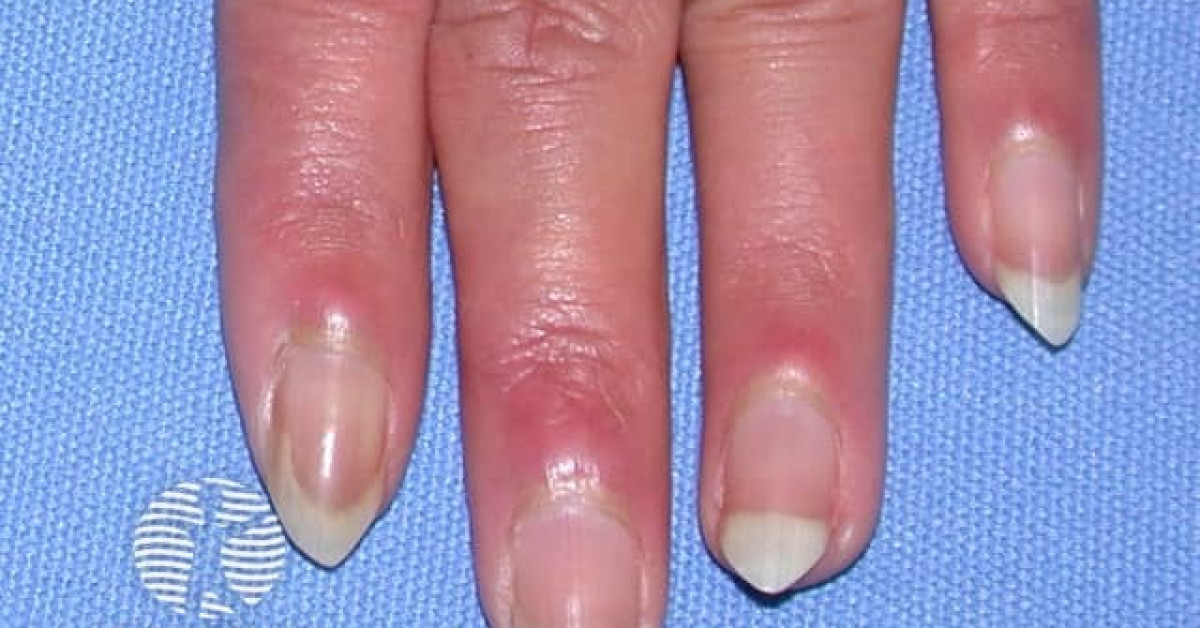 Mixed connective tissue disease image