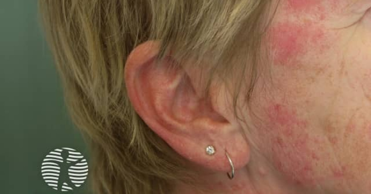 Mixed connective tissue disease image