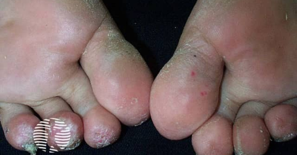 Discoid lupus erythematosus image