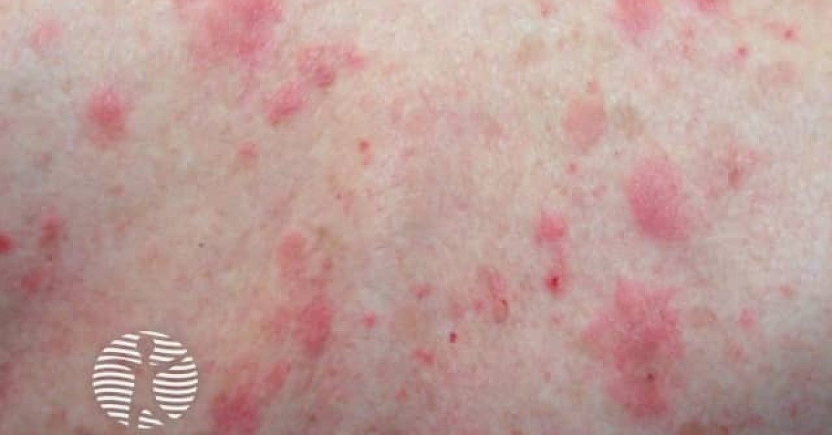 Bullous pemphigoid image