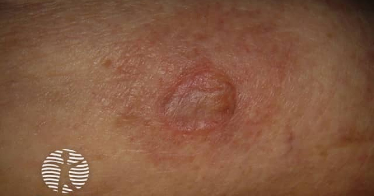 Bullous pemphigoid image