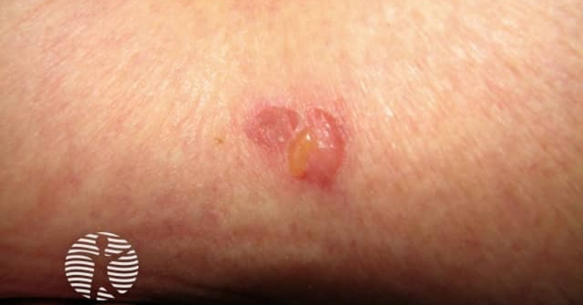 Bullous pemphigoid image