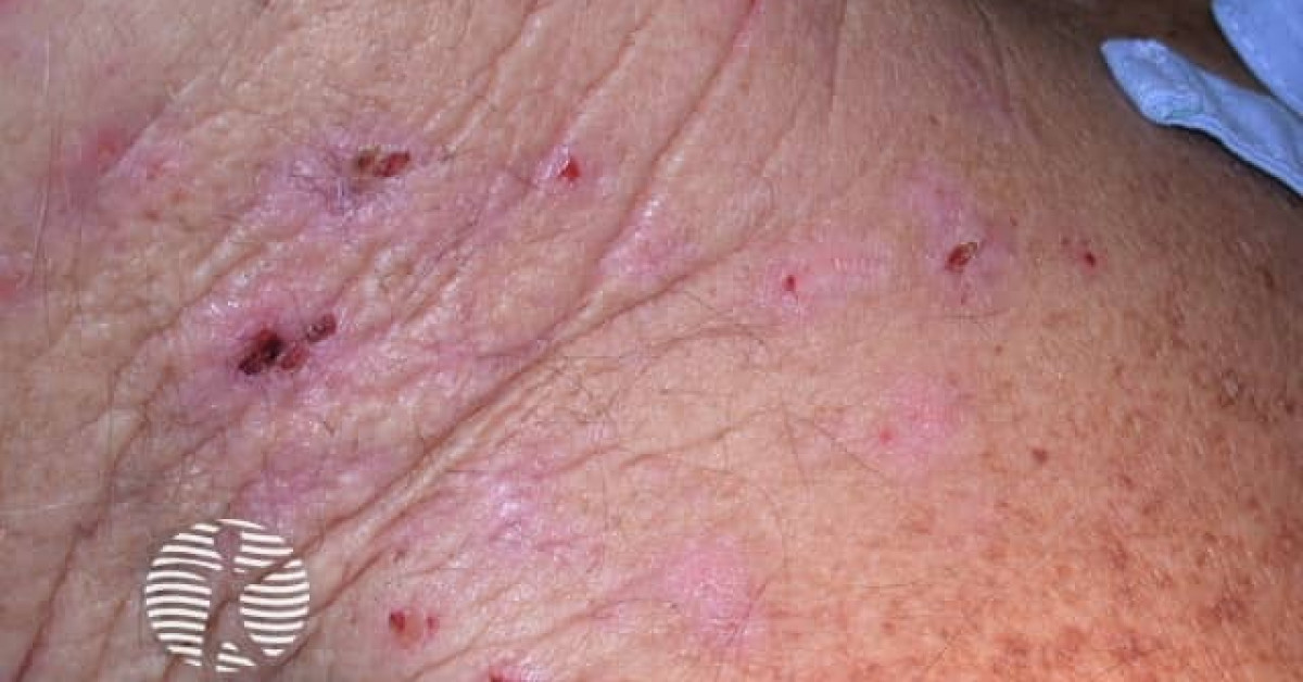 DermNet® - Bullous pemphigoid image