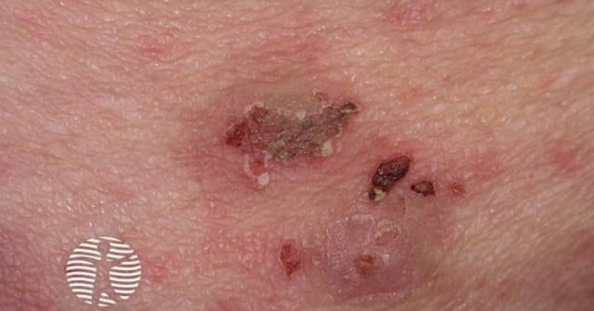 Bullous pemphigoid image