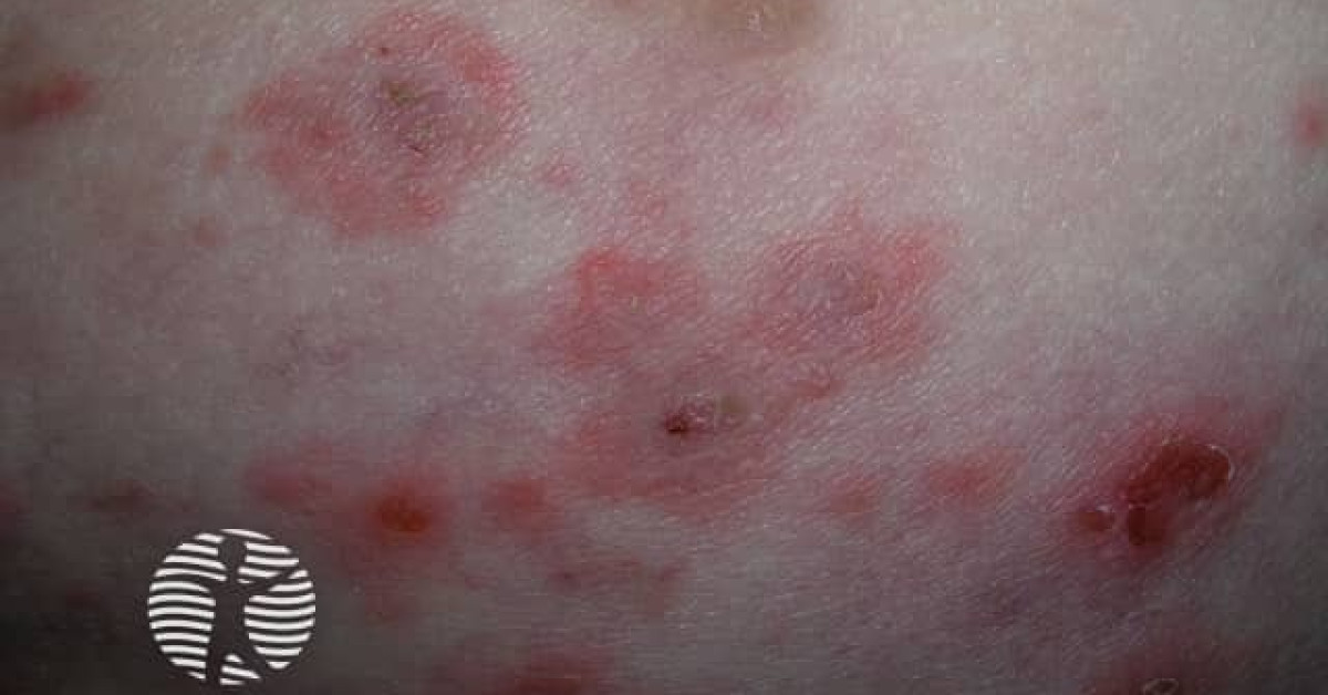 Bullous pemphigoid image