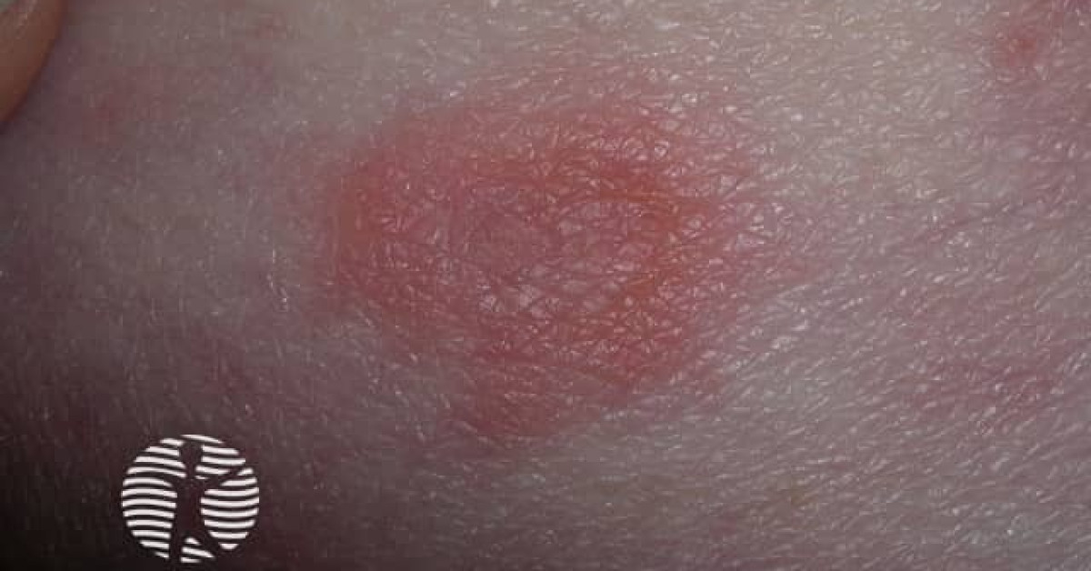 Bullous pemphigoid image