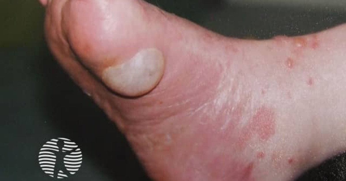 Bullous pemphigoid image