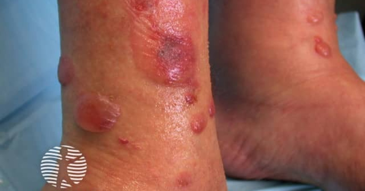 Bullous pemphigoid image