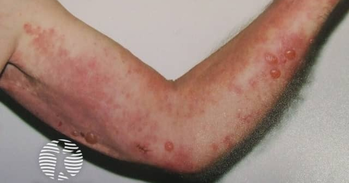 Bullous pemphigoid image