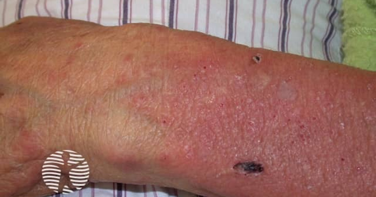 Bullous pemphigoid image