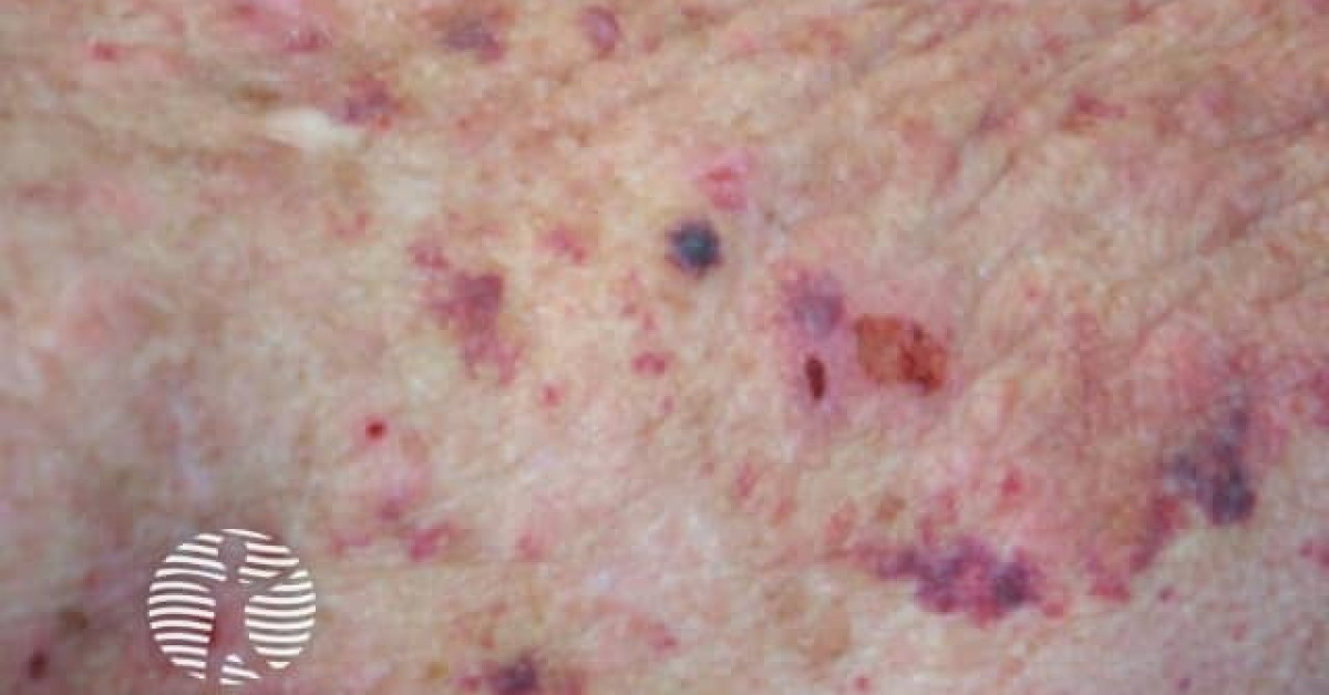 Bullous pemphigoid image