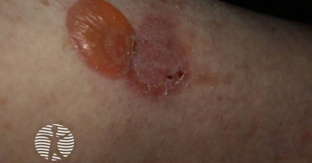 Bullous pemphigoid image