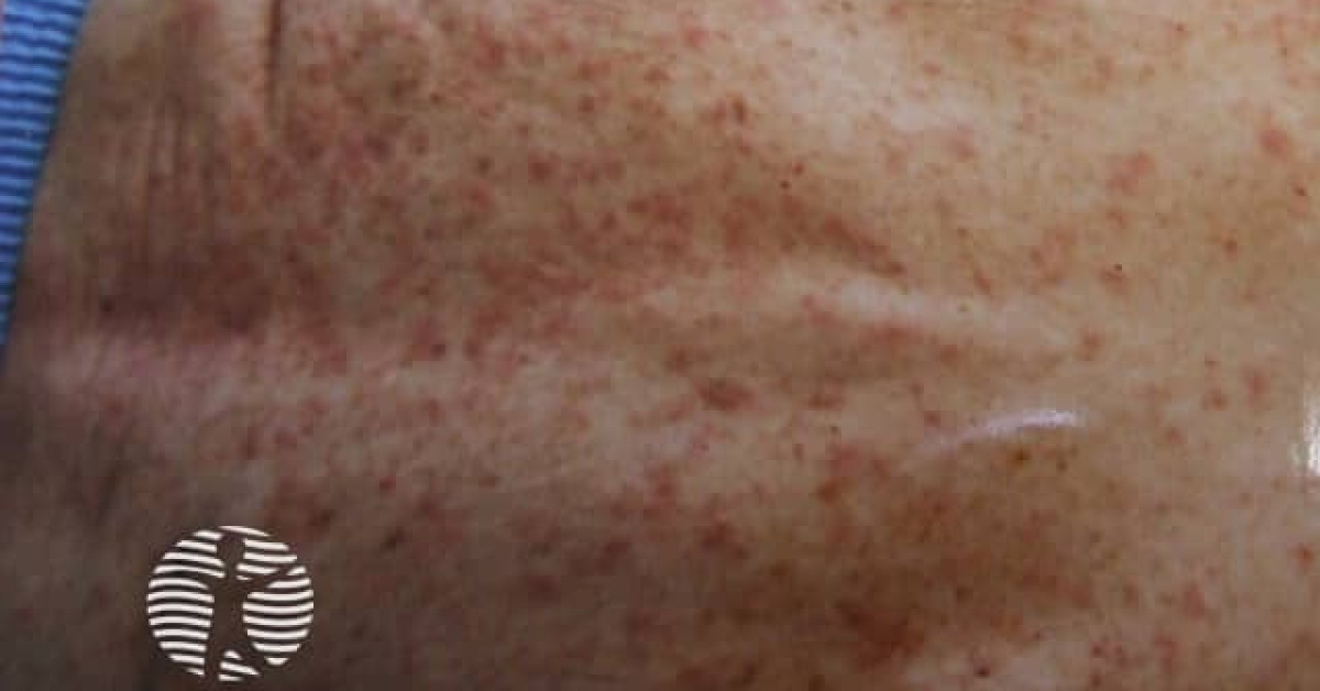 Bullous pemphigoid image