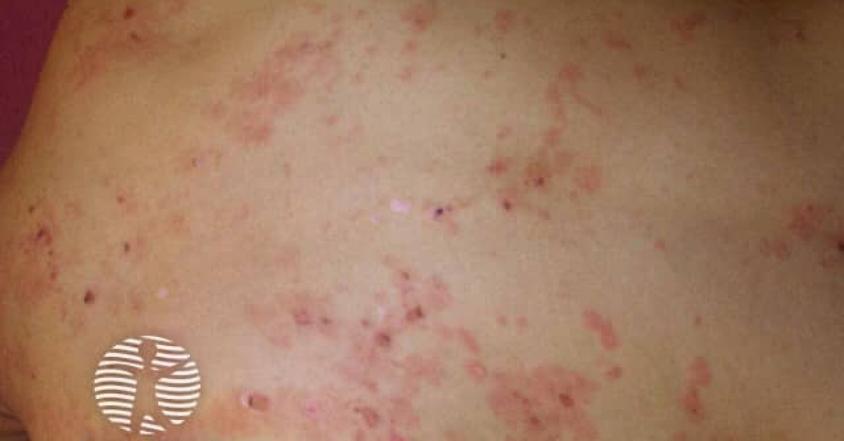 Bullous pemphigoid image