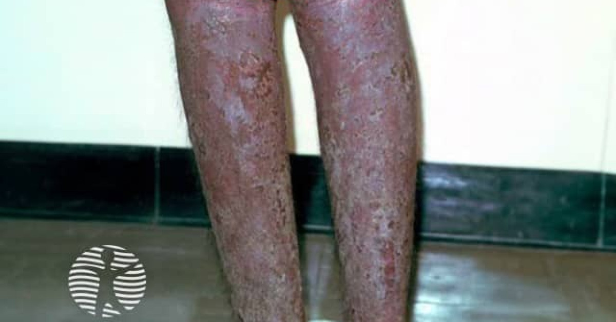 Pemphigus foliaceus image