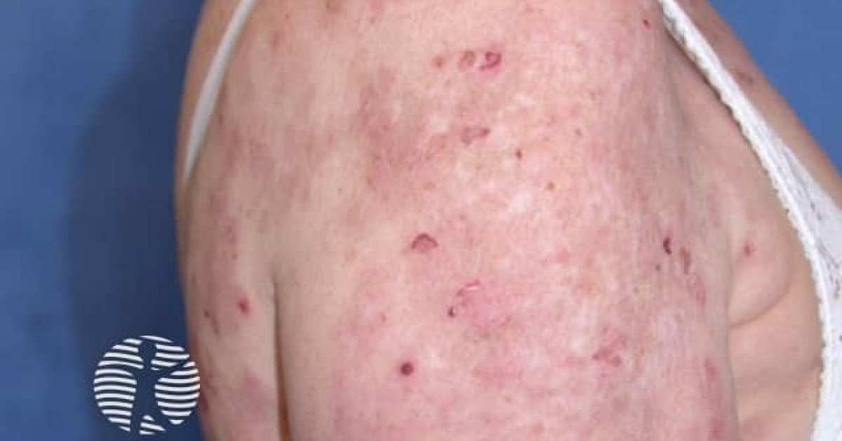 Pemphigus foliaceus image