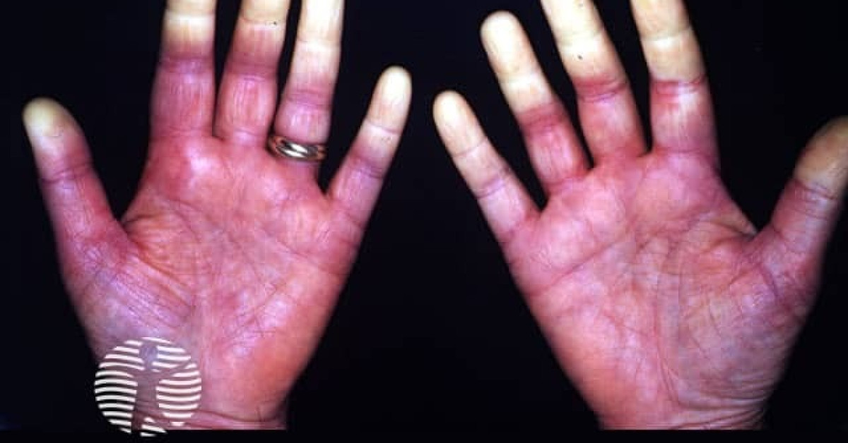 Raynaud phenomenon image
