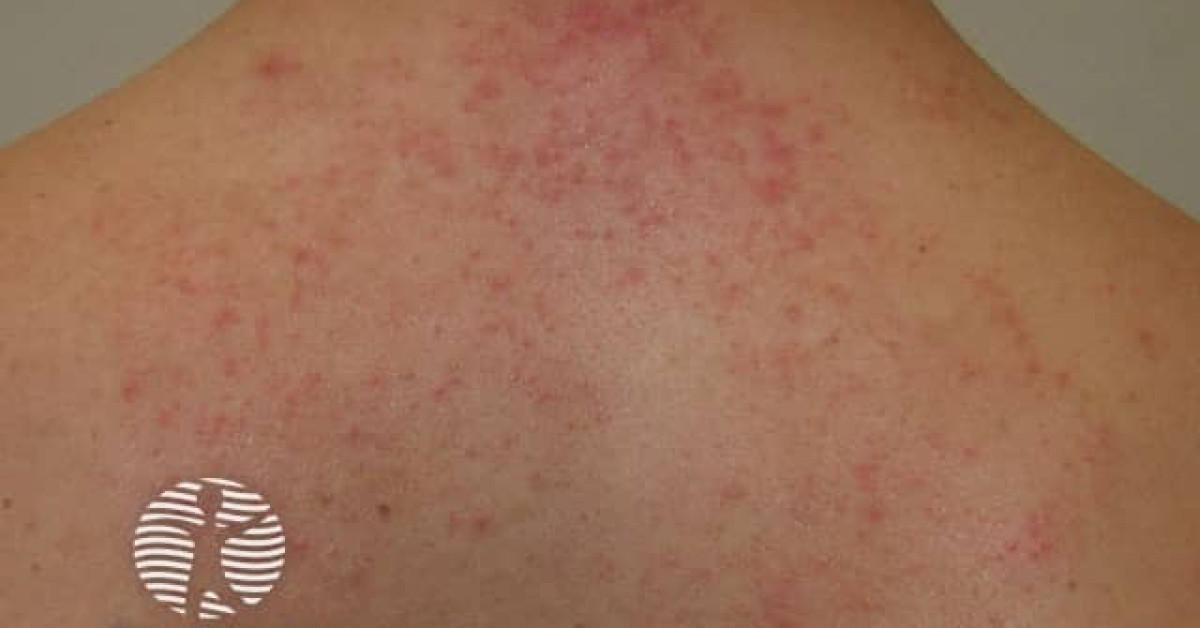 Reticular erythematous mucinosis image