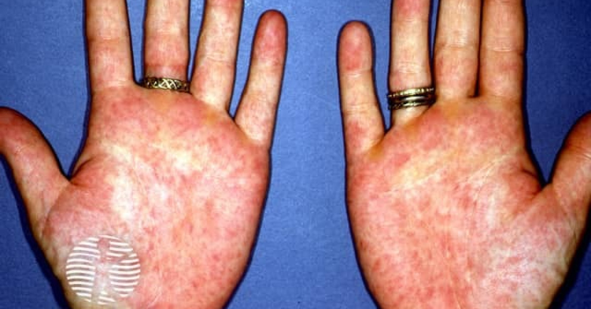 Palmar erythema in rheumatoid disease image