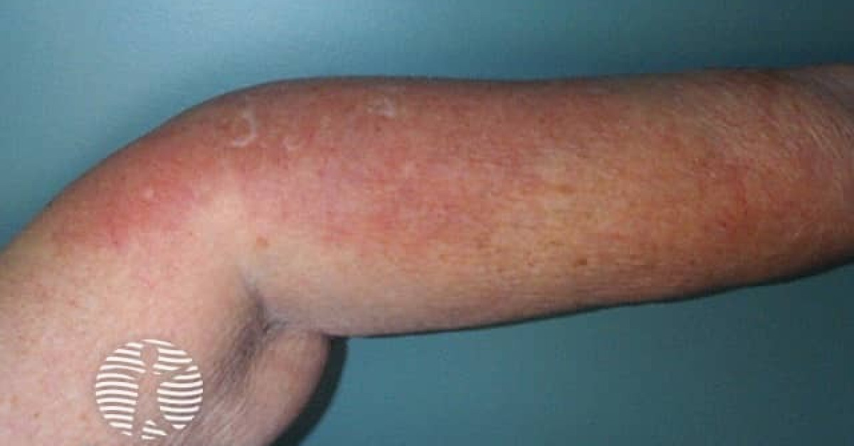 Neutrophilic dermatosis associated with rheumatoid arthritis image