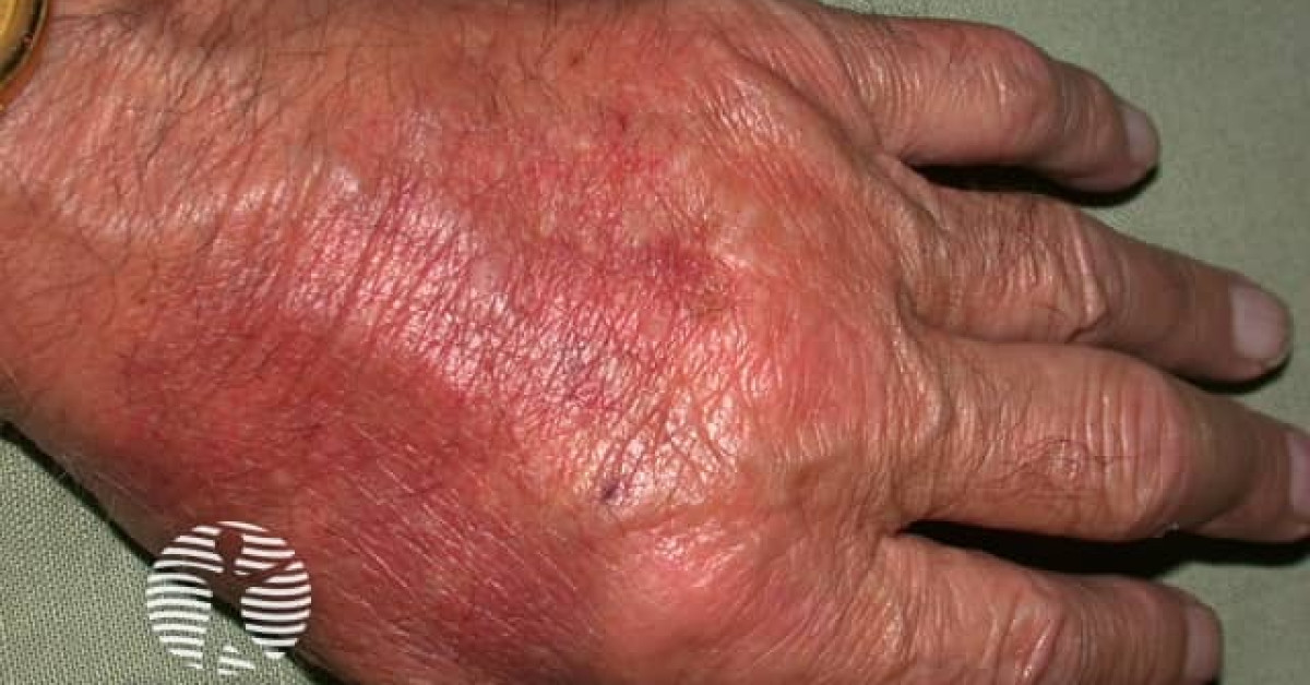 Neutrophilic dermatosis associated with rheumatoid arthritis image