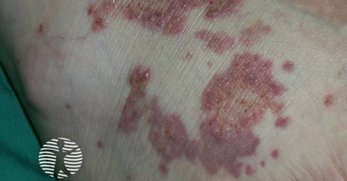Sjogren vasculitis image