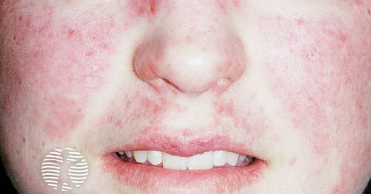 Systemic lupus erythematosus image