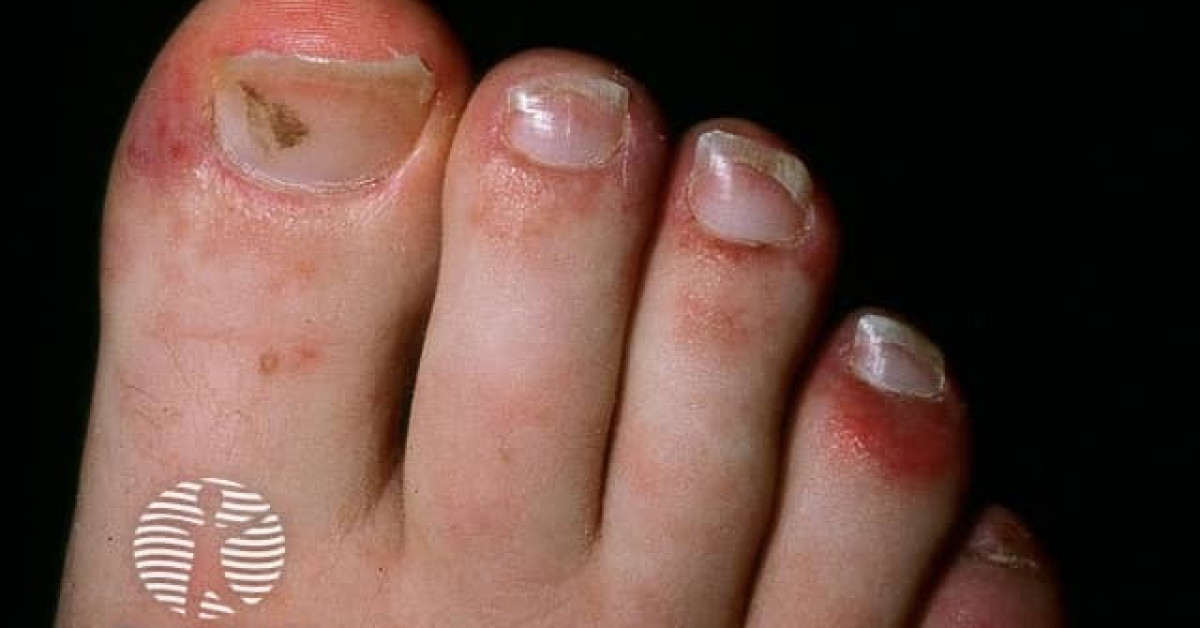 Systemic lupus erythematosus image