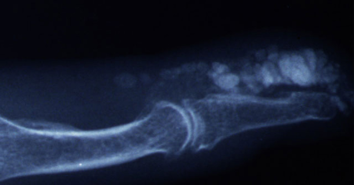 Calcinosis image
