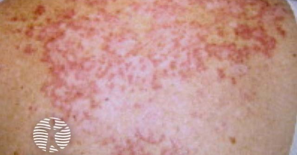 Subacute lupus erythematosus image