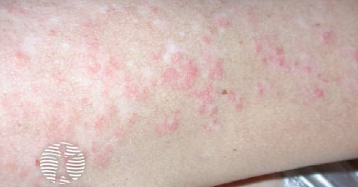 Subacute lupus erythematosus. SLE image