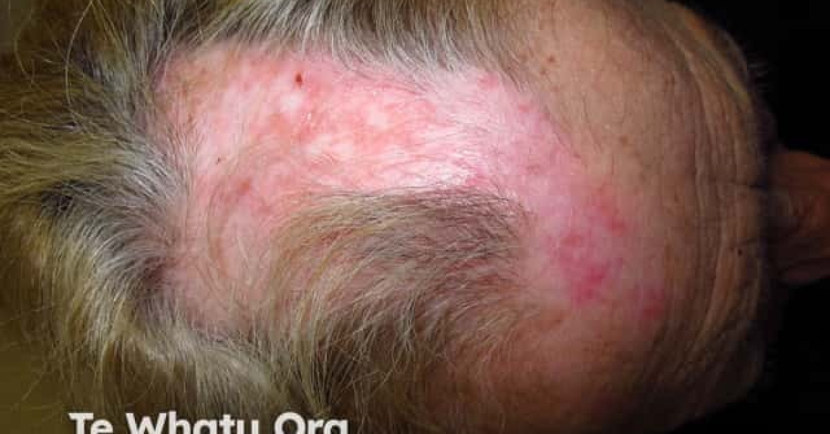 Chronic discoid lupus erythematosus image