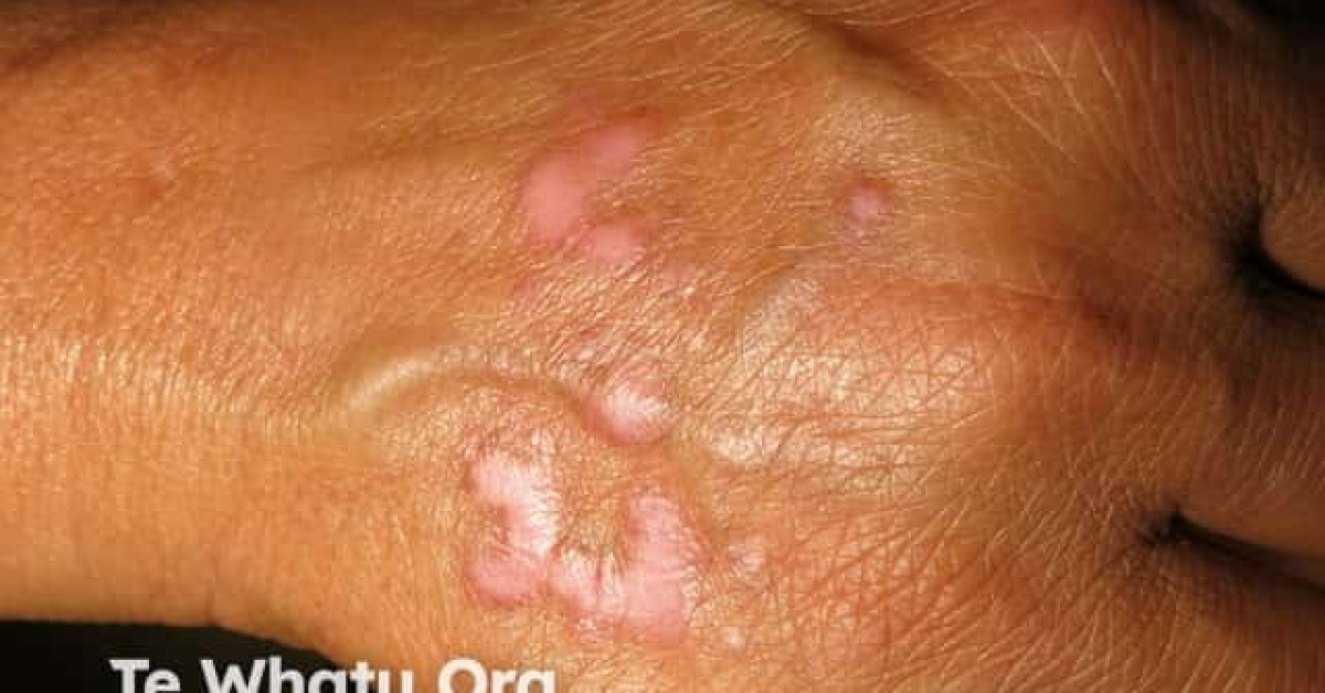 Chronic discoid lupus erythematosus image