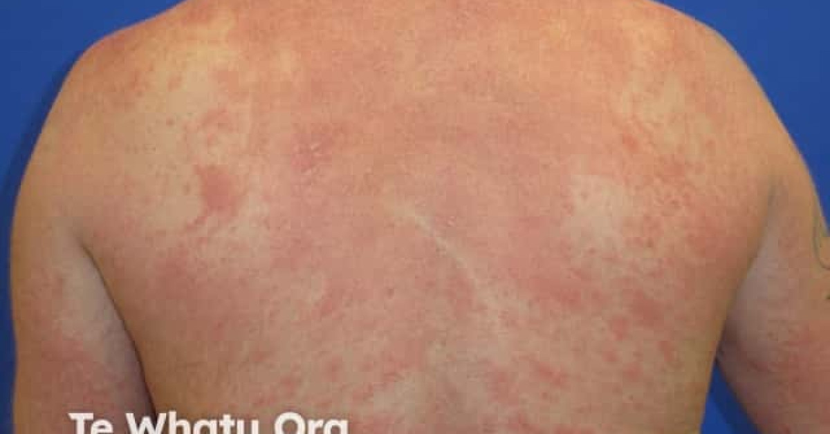 Lichenoid reaction induced by immunoglobulin infusion image