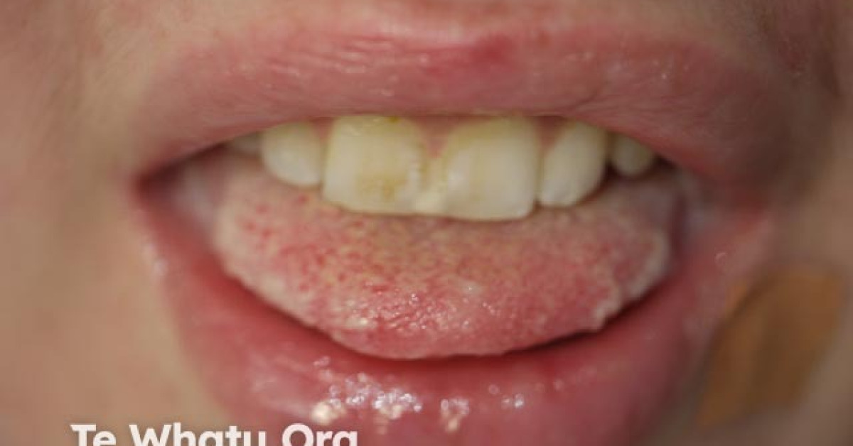 Lupus And Swollen Tongue