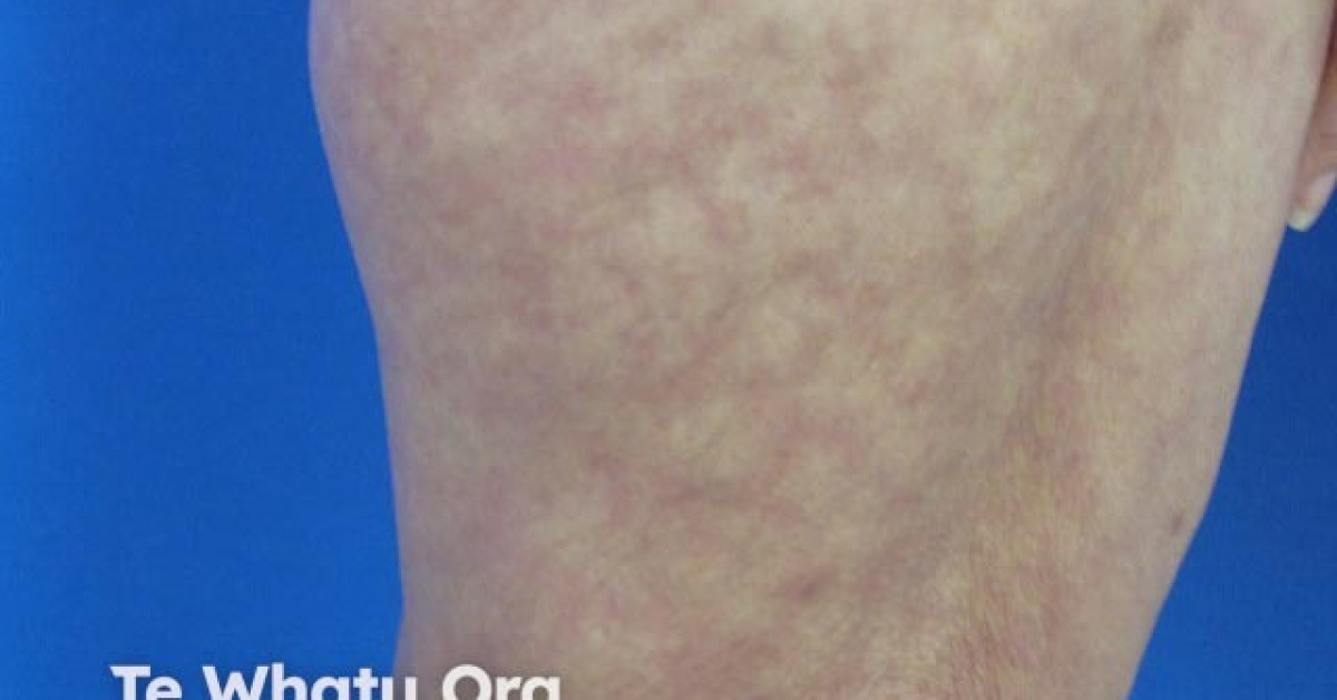 Systemic lupus erythematosus image