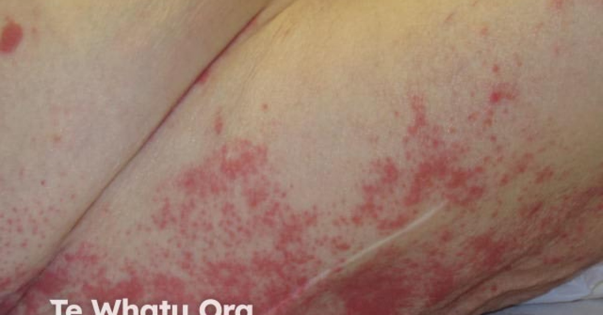 Incontinence dermatitis image