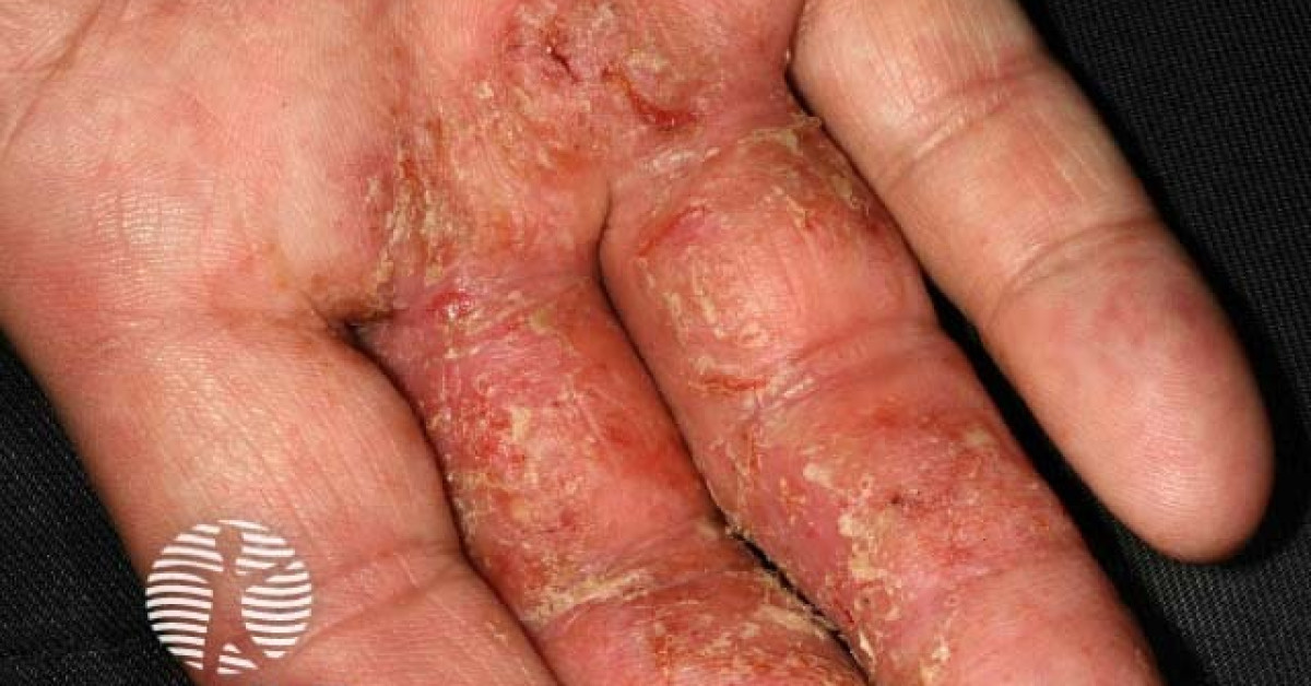 Infected vesicular hand dermatitis image