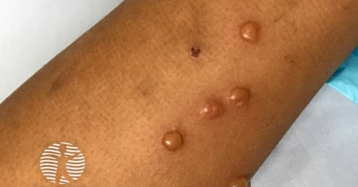 Bullous insect bites image