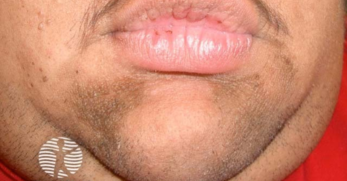 Skin signs of insulin resistance image