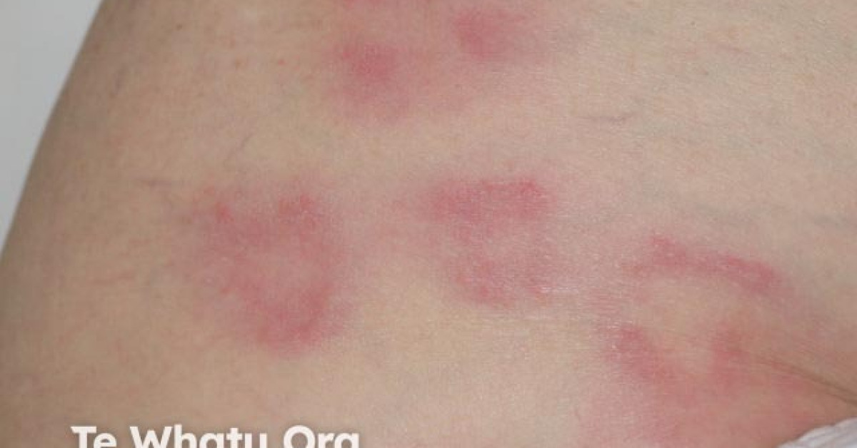 Interstitial granulomatous dermatitis image