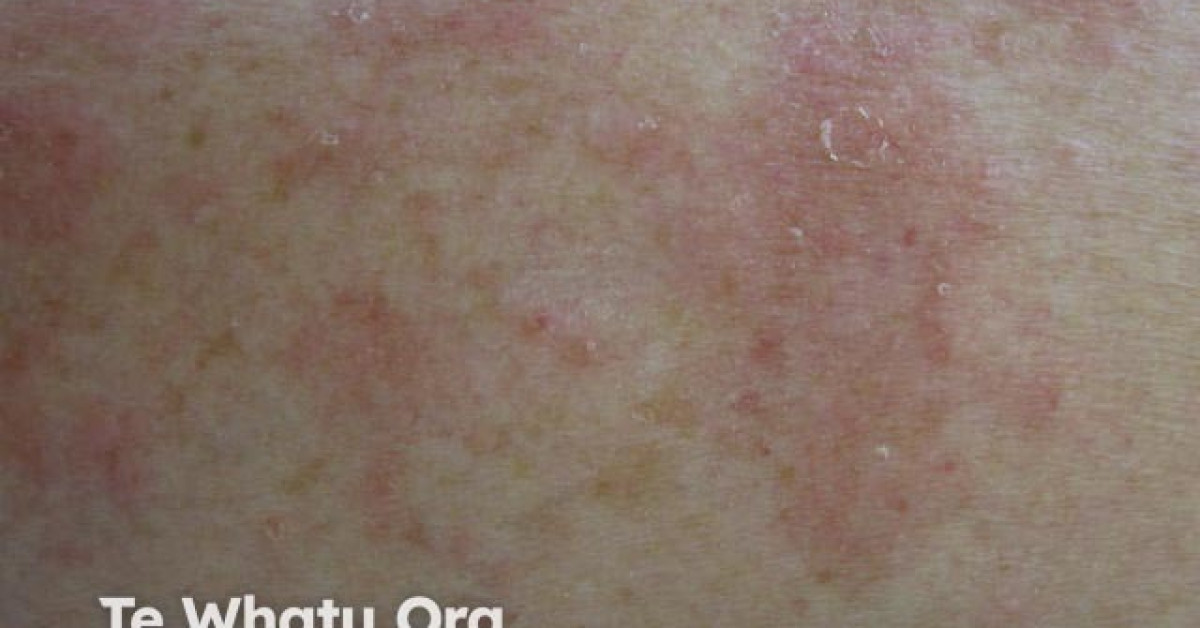 Interstitial granulomatous dermatitis image