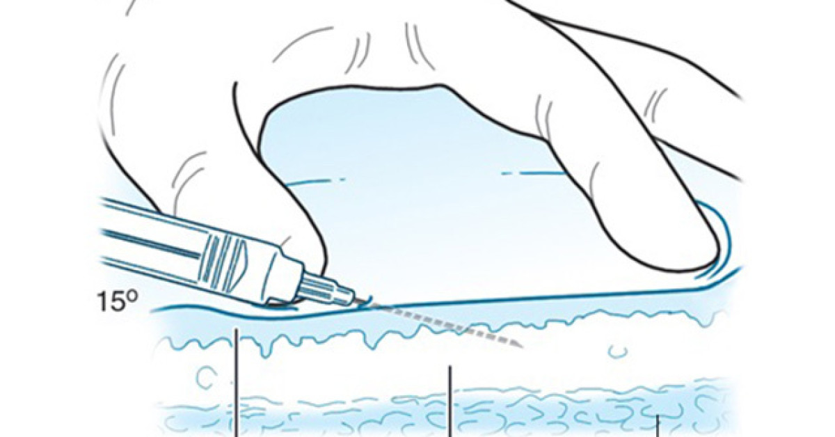 Intralesional injection image