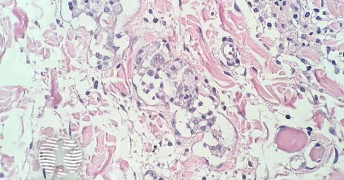 Intravascular lymphoma image