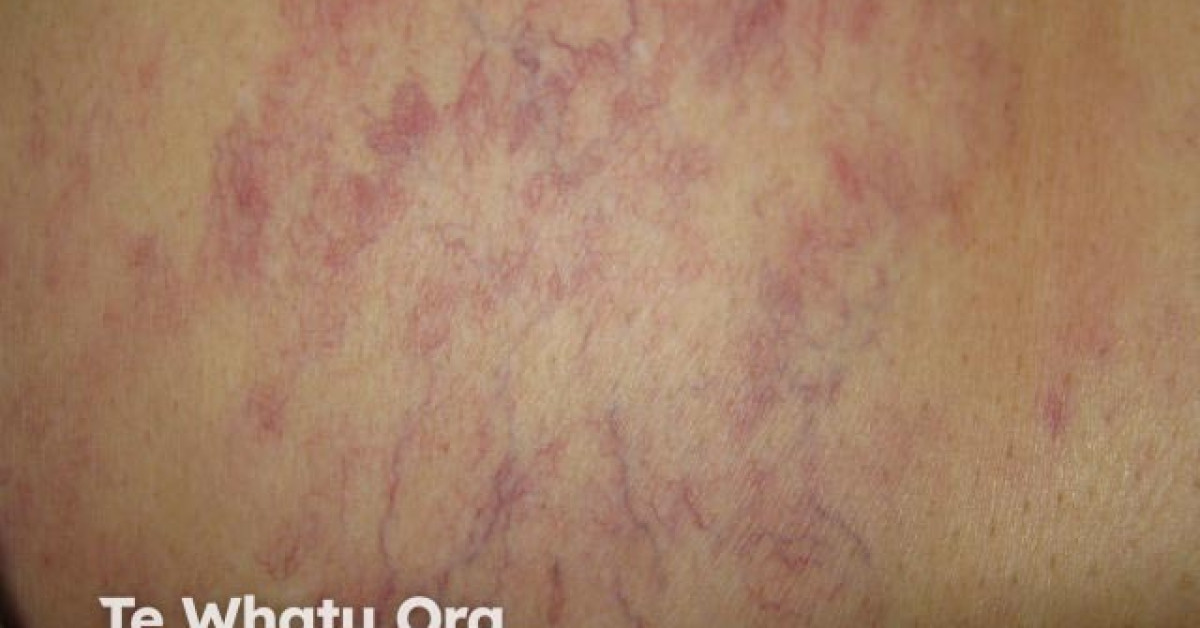 Telangiectatic intravascular lymphoma image