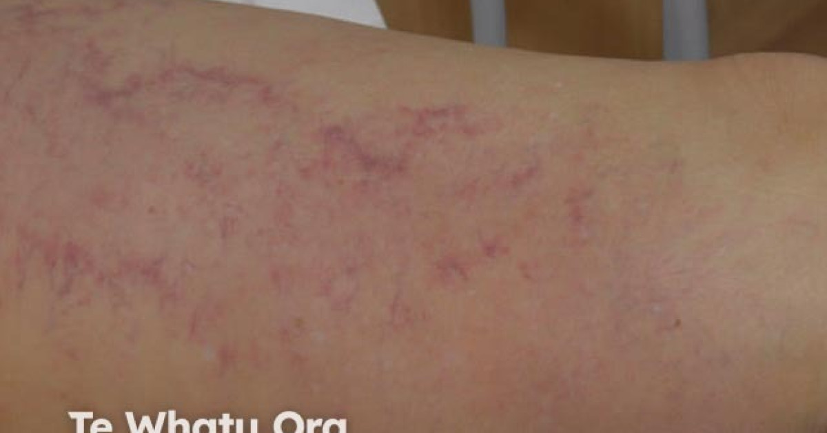 Telangiectatic intravascular lymphoma image