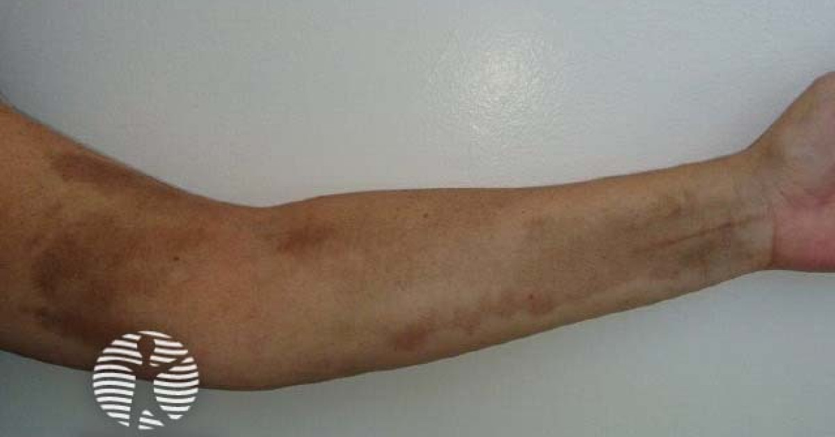 Iron infusion stain image