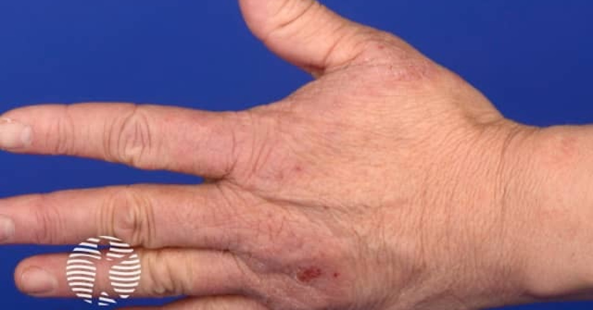 Irritant contact hand dermatitis image