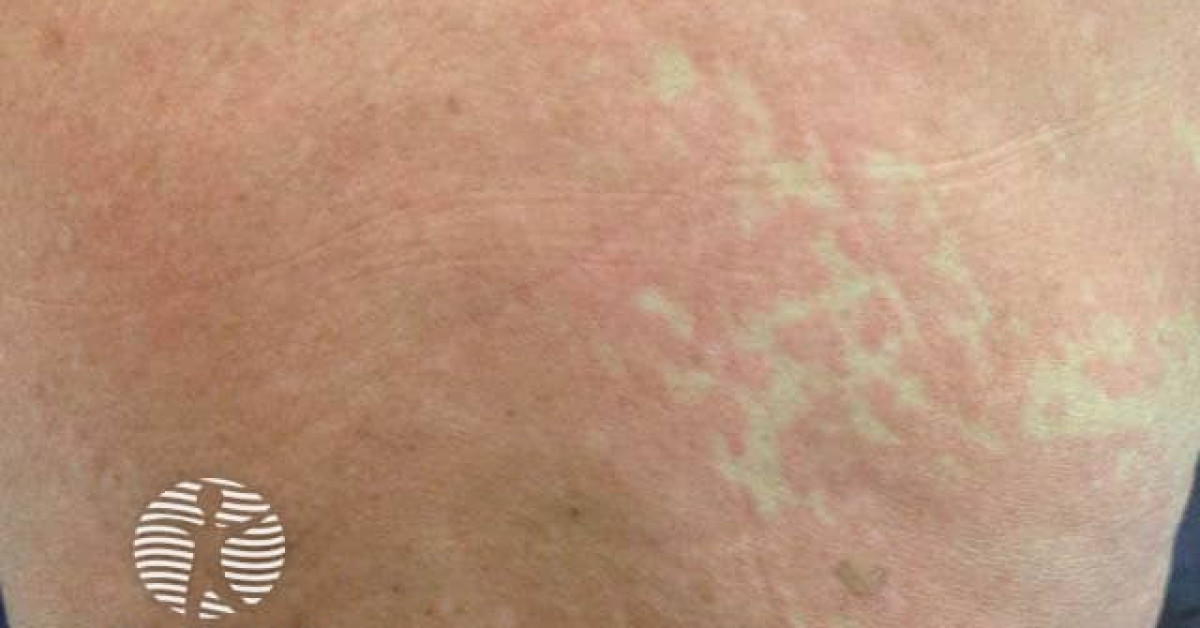 Exanthem with islands of sparing image