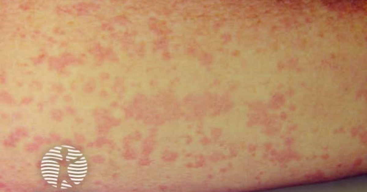 Systemic juvenile idiopathic arthritis image